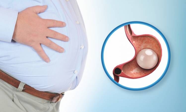 Intragastric balloons With Lifestyle Modification lead to significant ...