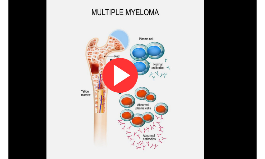Multiple Myeloma: Diagnosis, Prevention and Treatment