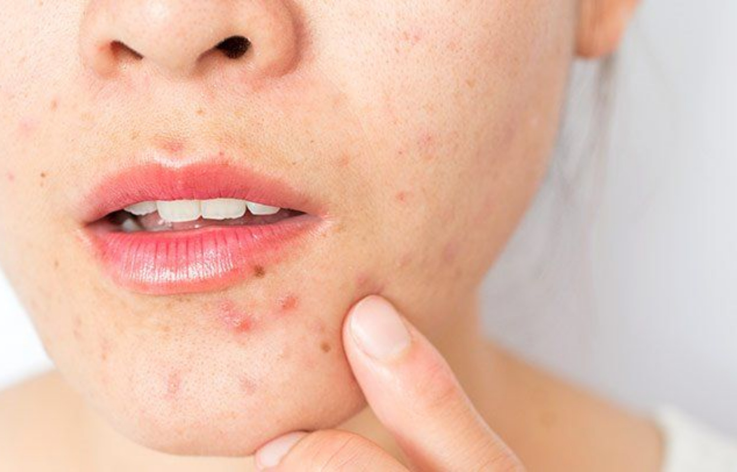 Acne linked to development of insulin resistance: Study