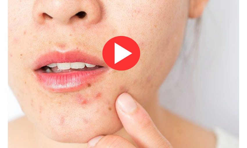 An overview of adult acne by Dr. Amit Vij