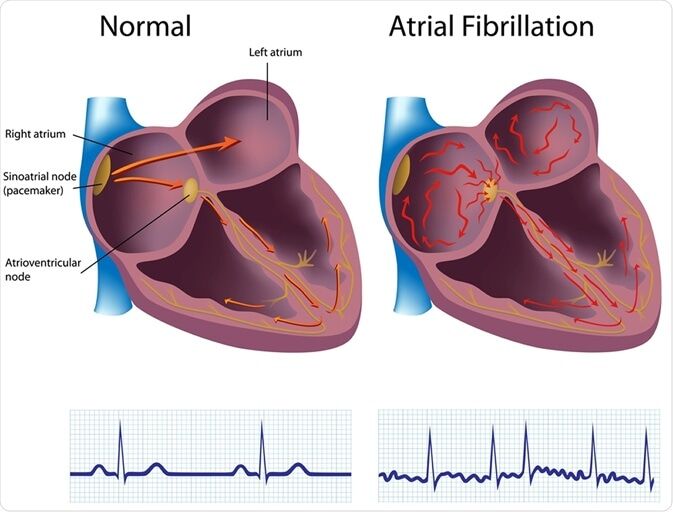 Anterior-lateral defibrillation pad position effective for ...