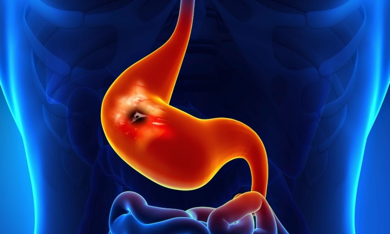 Hemostatic powder bests standard endoscopic treatment for Hemostasis in ...