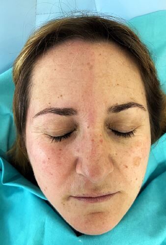 Oxybutynin and propranolol combo successfully resolves symptoms in ...