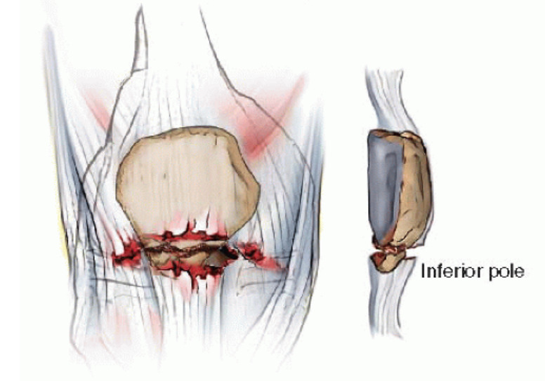 Anchor suture fixation for treatment of inferior patellar pole ...