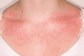 Lirentelimab efficient for antihistamine-refractory chronic urticaria ...