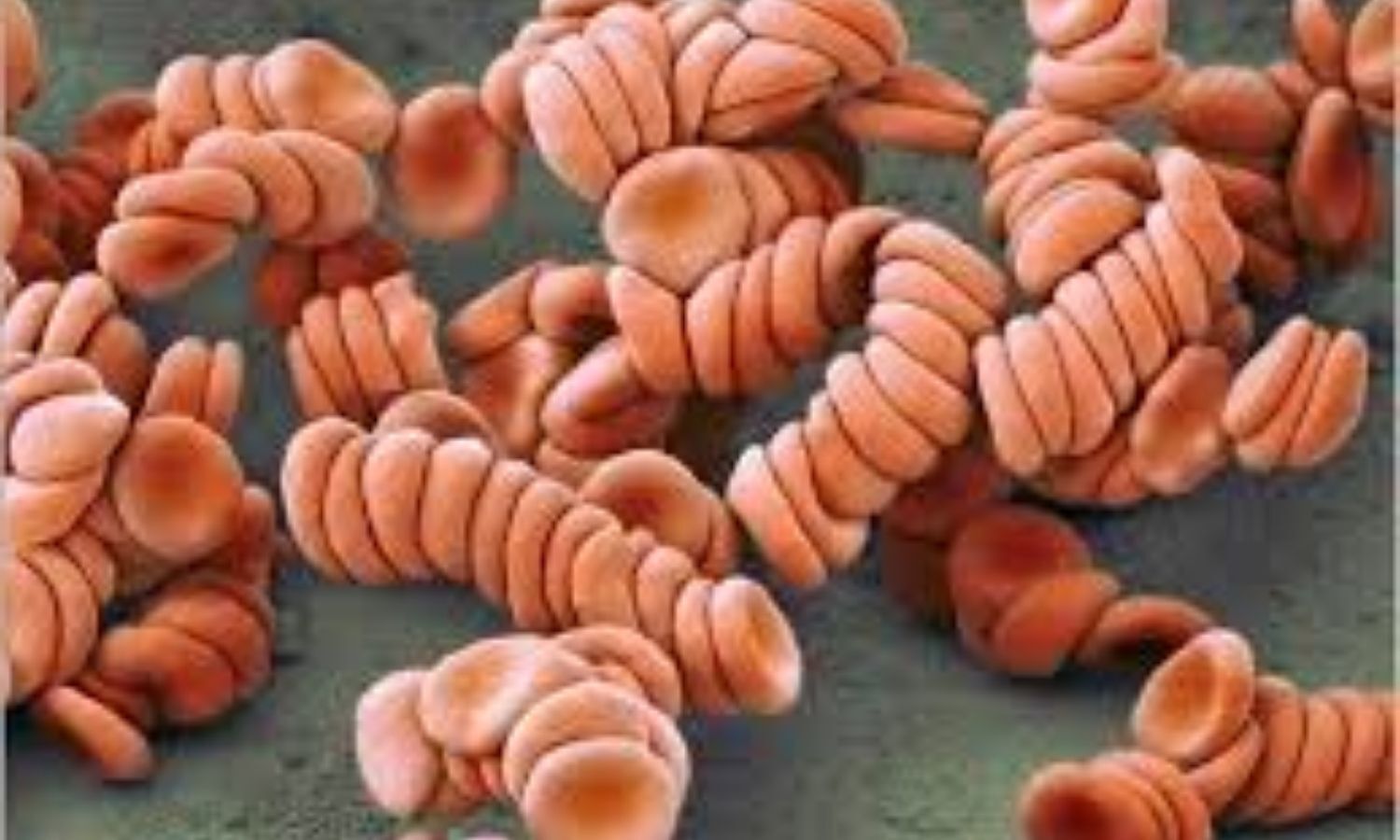 Erythrocyte aggregation in diabetes patients with hyper cholesterol ...