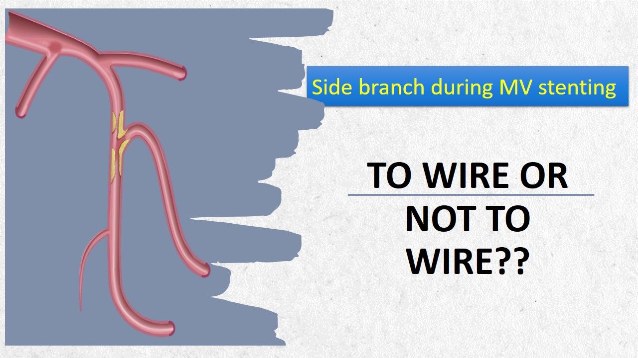 Jailing side branch is beneficial to secure its patency, finds JACC study