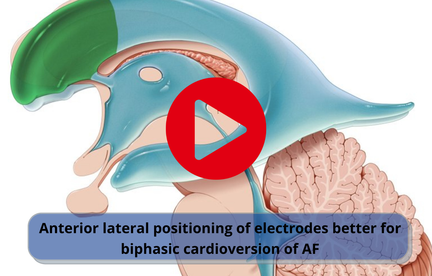 Anterior lateral positioning of electrodes better for biphasic ...