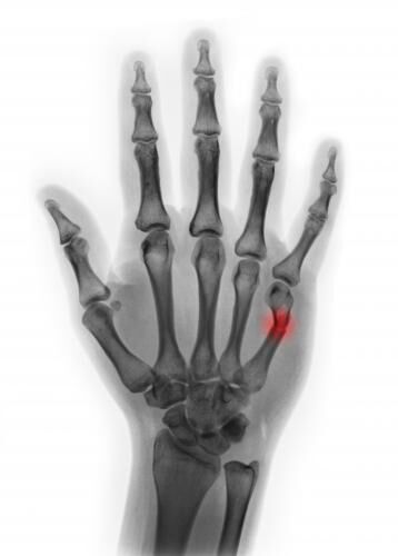 L-pinning in 5th MC neck fracture accelerates recovery in adolescents ...