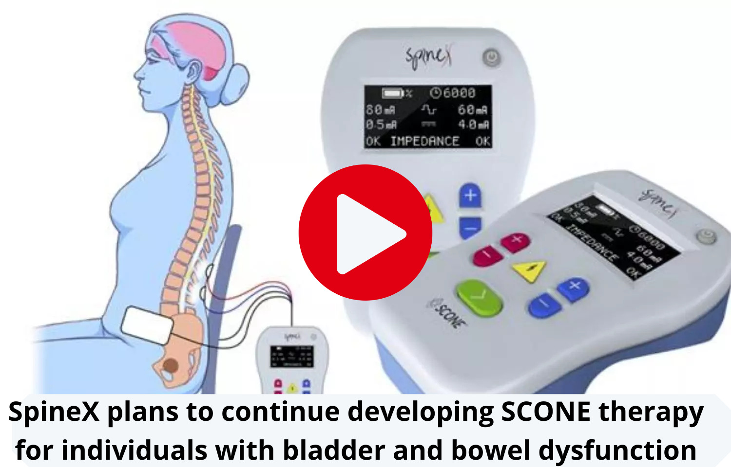 SpineX reports successful first in human study results of SCONE therapy