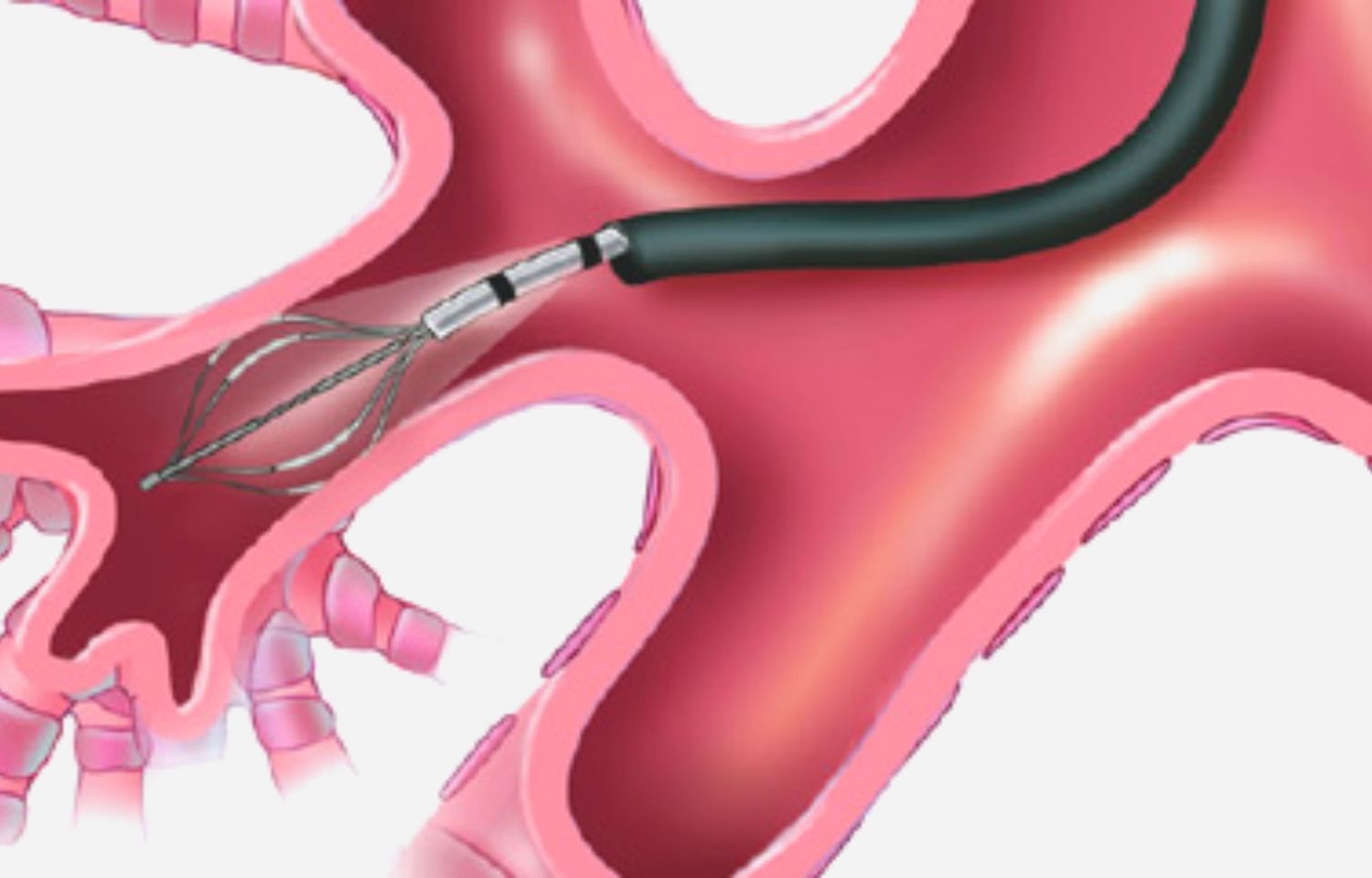 Bronchial thermoplasty found safe, effective and durable treatment for ...
