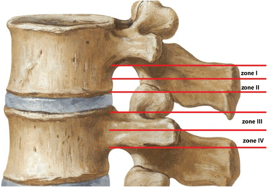 Complication rates of 3 posterior decompression techniques for lumbar ...