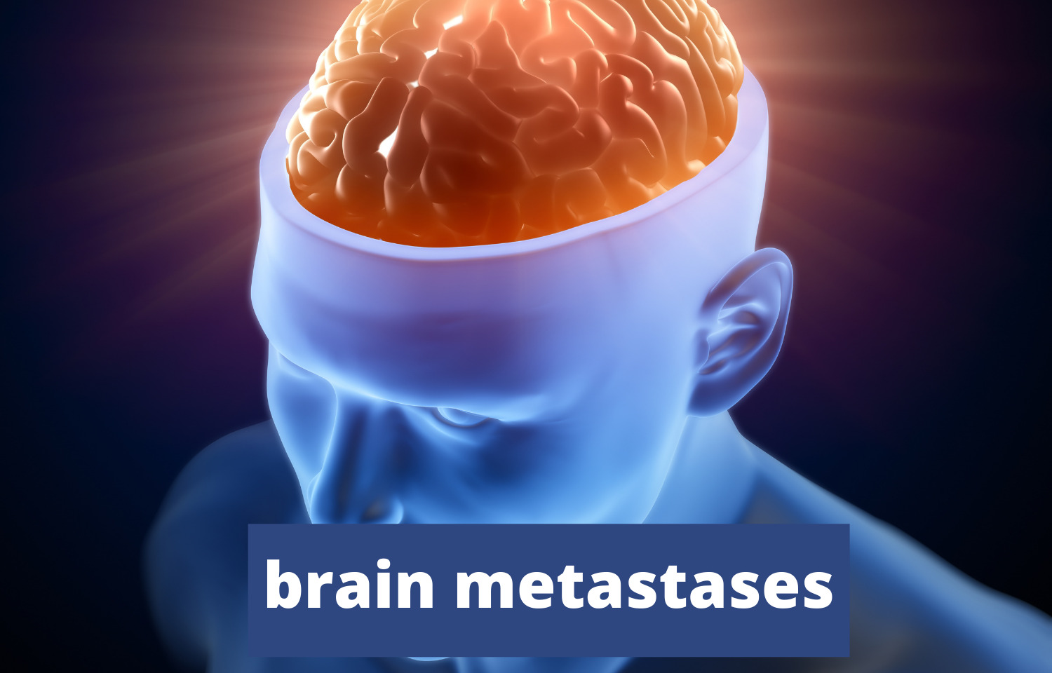 ASTRO issues clinical guideline on radiation therapy for brain metastases