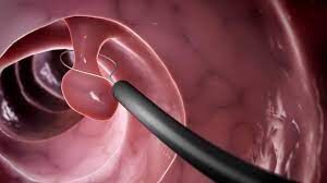 Cold forceps polypectomy non inferior to cold snare polypectomy for ...