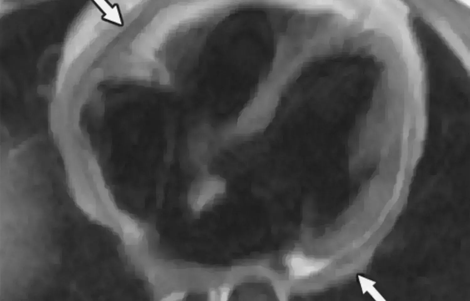 Cardiac MR provides superior diagnostic information in pericarditis cases