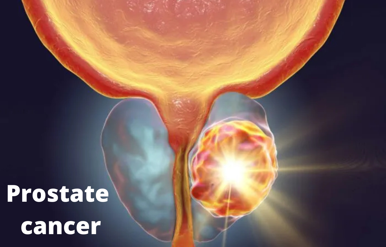 Prostate cancer linked to increased risk of VTE among men