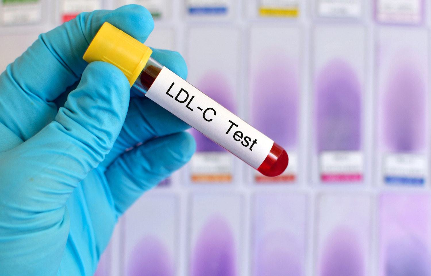 High total cholesterol and LDL-C levels during midlife reduce risk of ...