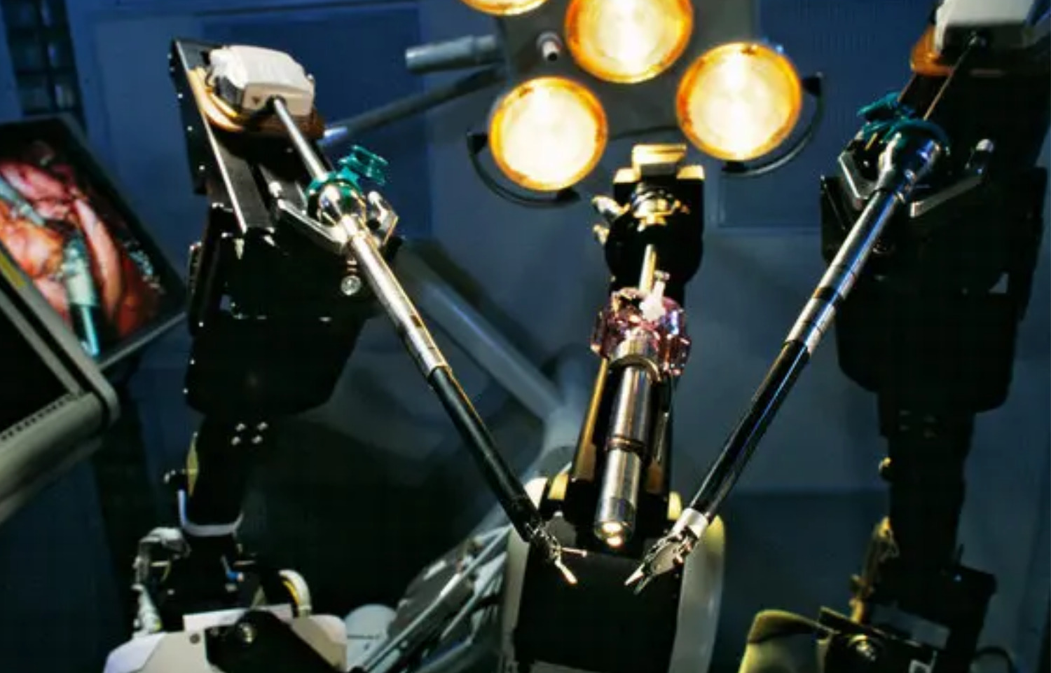 Massive fibroid in uterus, Woman treated with robotic minimally ...