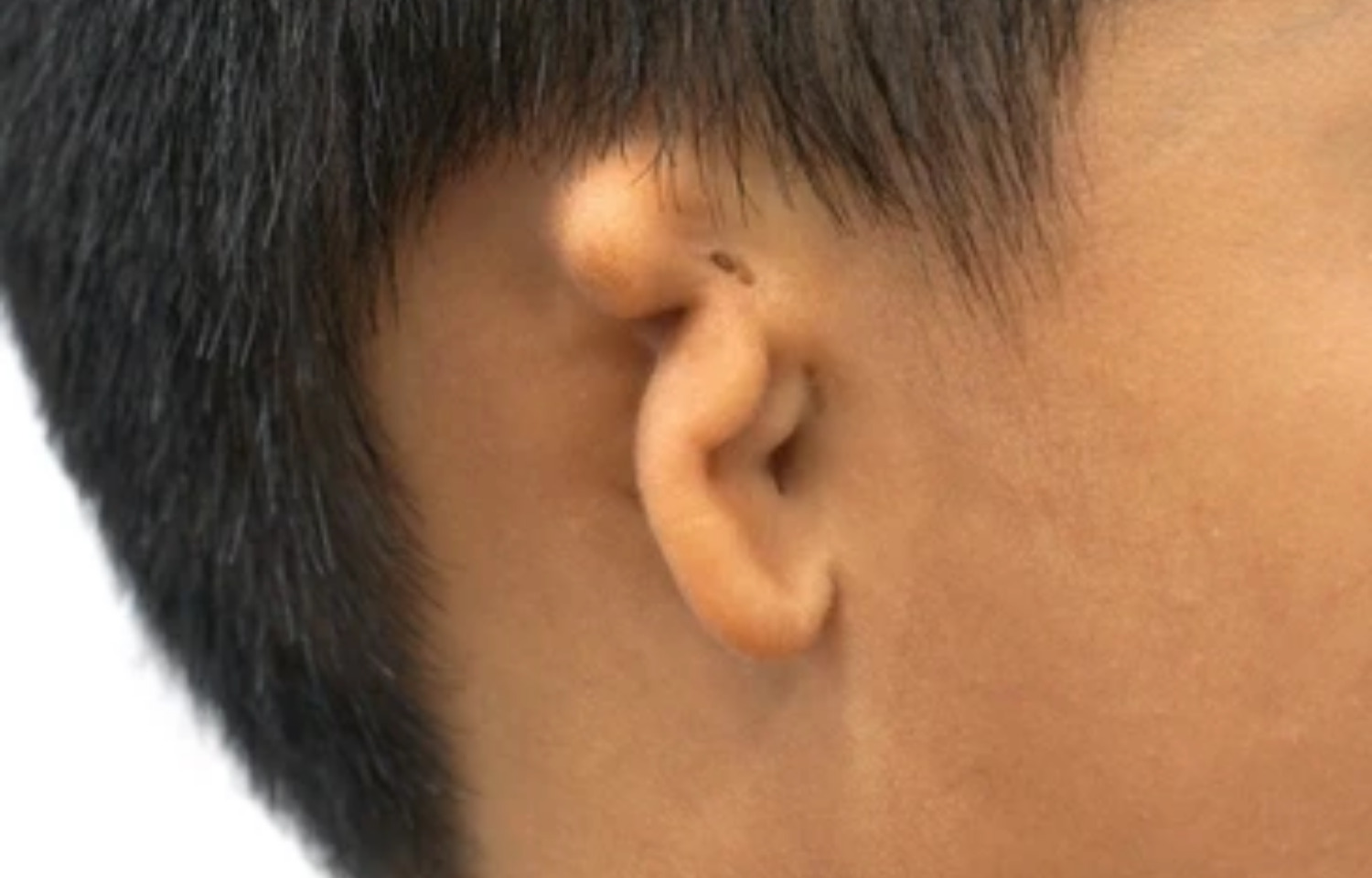 Surgeons transplant 3D ear made of living cells