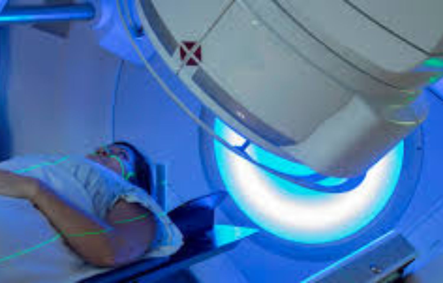 Curative-intent radiotherapy with IMPT for Oropharyngeal Carcinoma ...