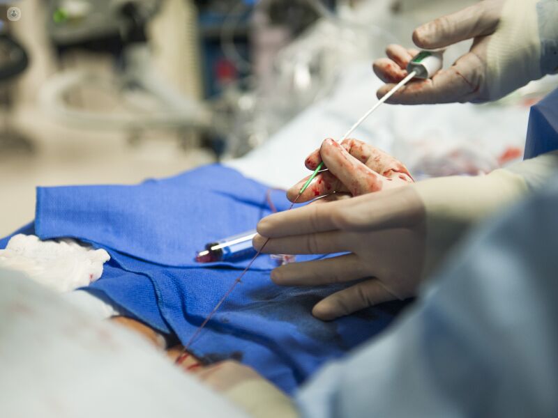 Transcatheter Arterial Embolization safe & effective treatment for ...