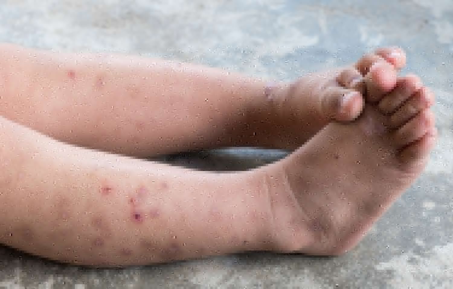 FDA approves dupilumab for treatment of atopic dermatitis in pediatric ...