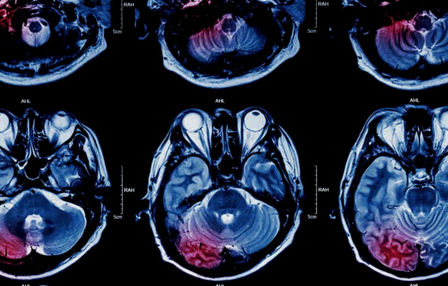 Rapid MRI in suspected stroke patients cuts hosptial length of stay ...