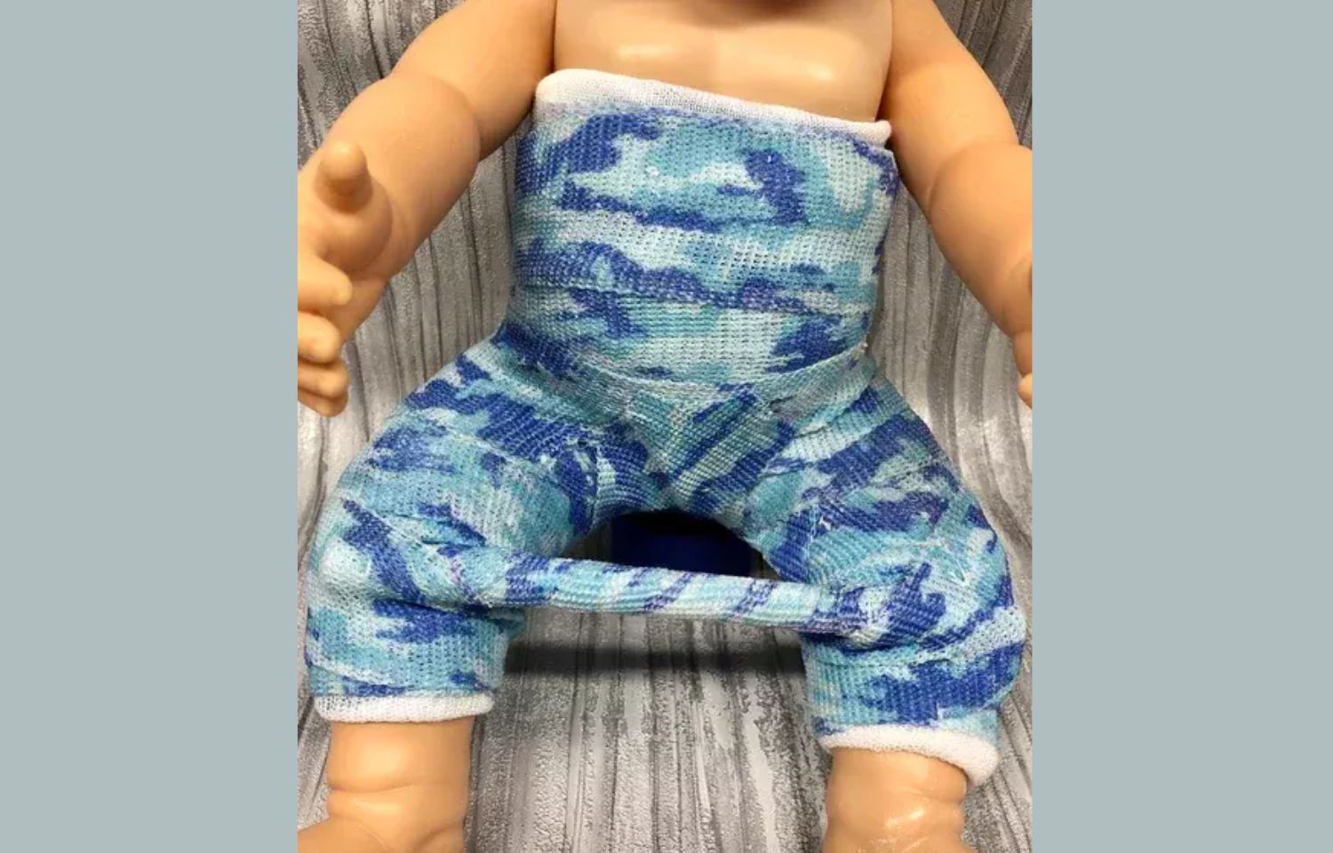 Hip Spica Stroller an innovative device that enhances post spica care ...