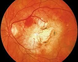 Port Delivery System better than Intravitreal Injection for Patients ...