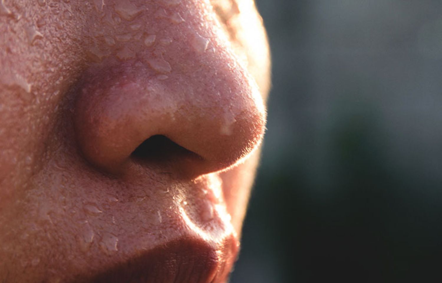 Topical glycopyrrolate provides comparable outcomes as Botox for facial ...