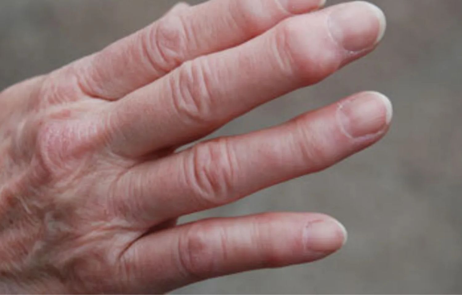 Swelling and not tenderness of joints better predicts synovitis in ...