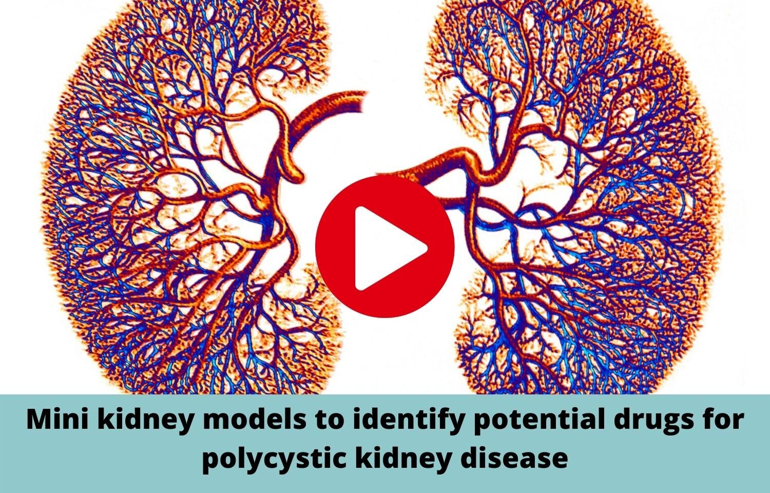 Mini kidney models to identify potential drugs for polycystic kidney ...