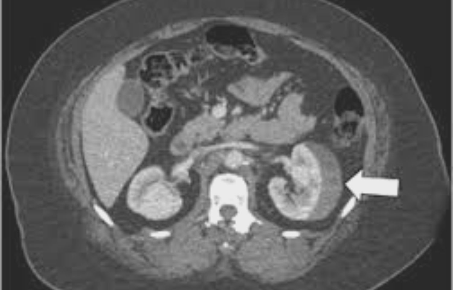 Repeat CT imaging can be safely omitted in uncomplicated blunt renal ...