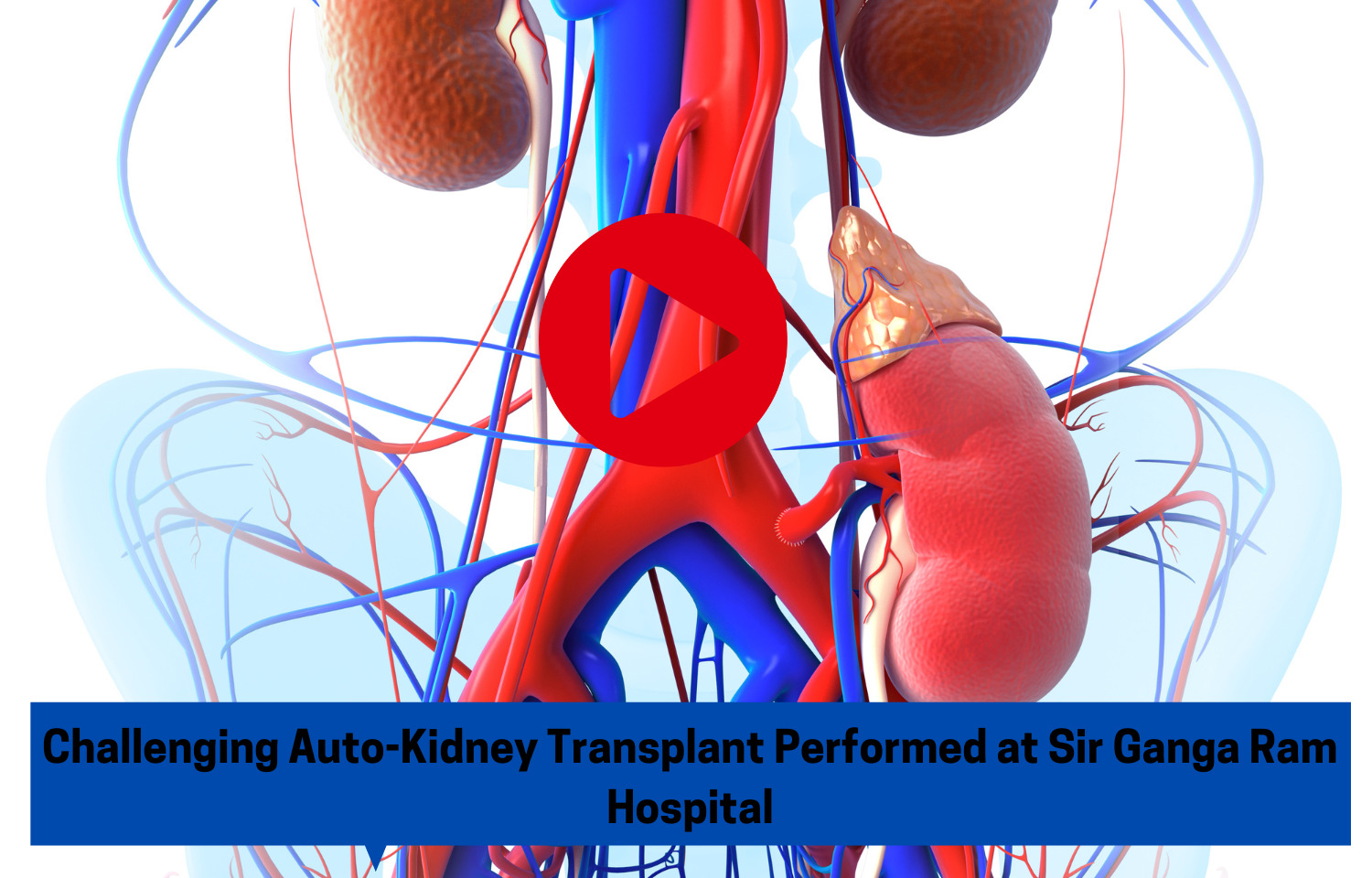 Both kidneys on right side- a challenging auto-Kidney transplant ...