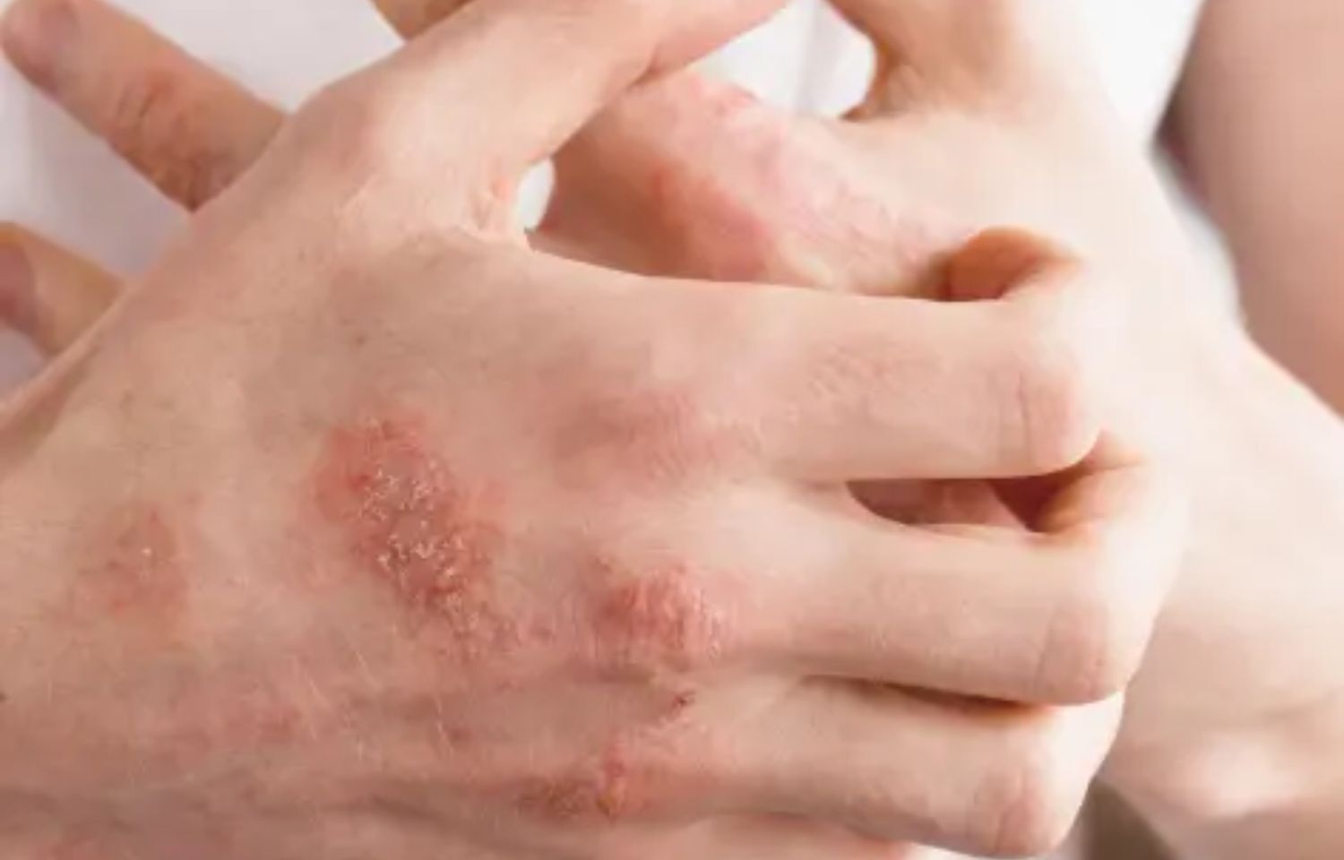 Domestic hard water increases eczema prevalence in adults: Study