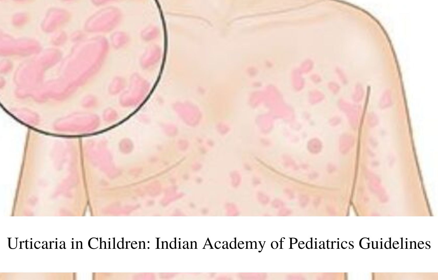 Urticaria in Children: Indian Academy of Pediatrics Guidelines