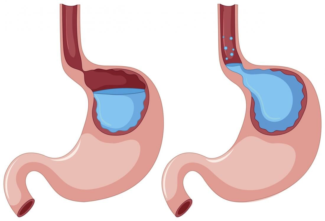 Transoral Incisionless Fundoplication effective in reducing ...