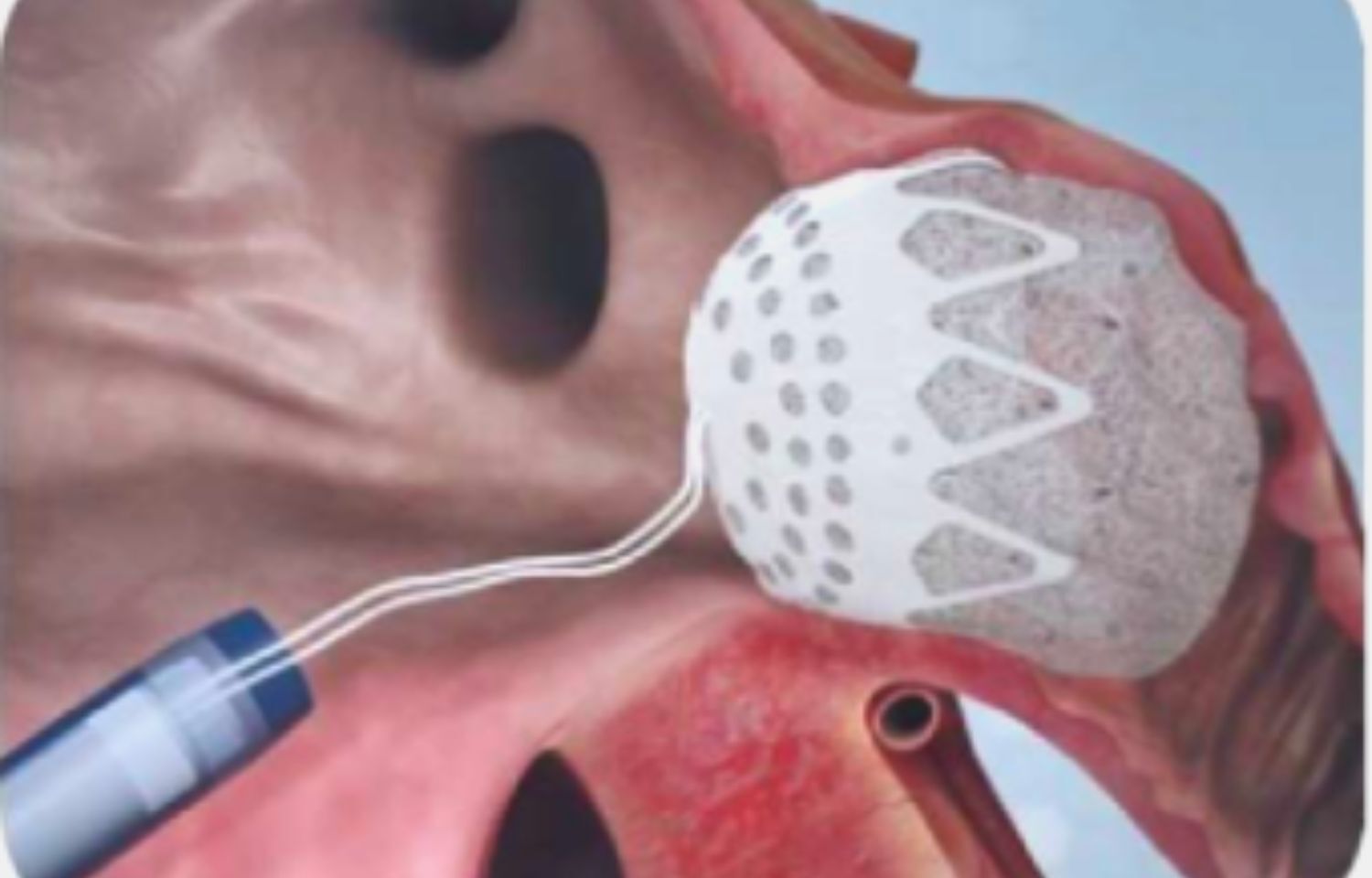 Peridevice leaks after left atrial appendage closure tied to poorer 5 ...