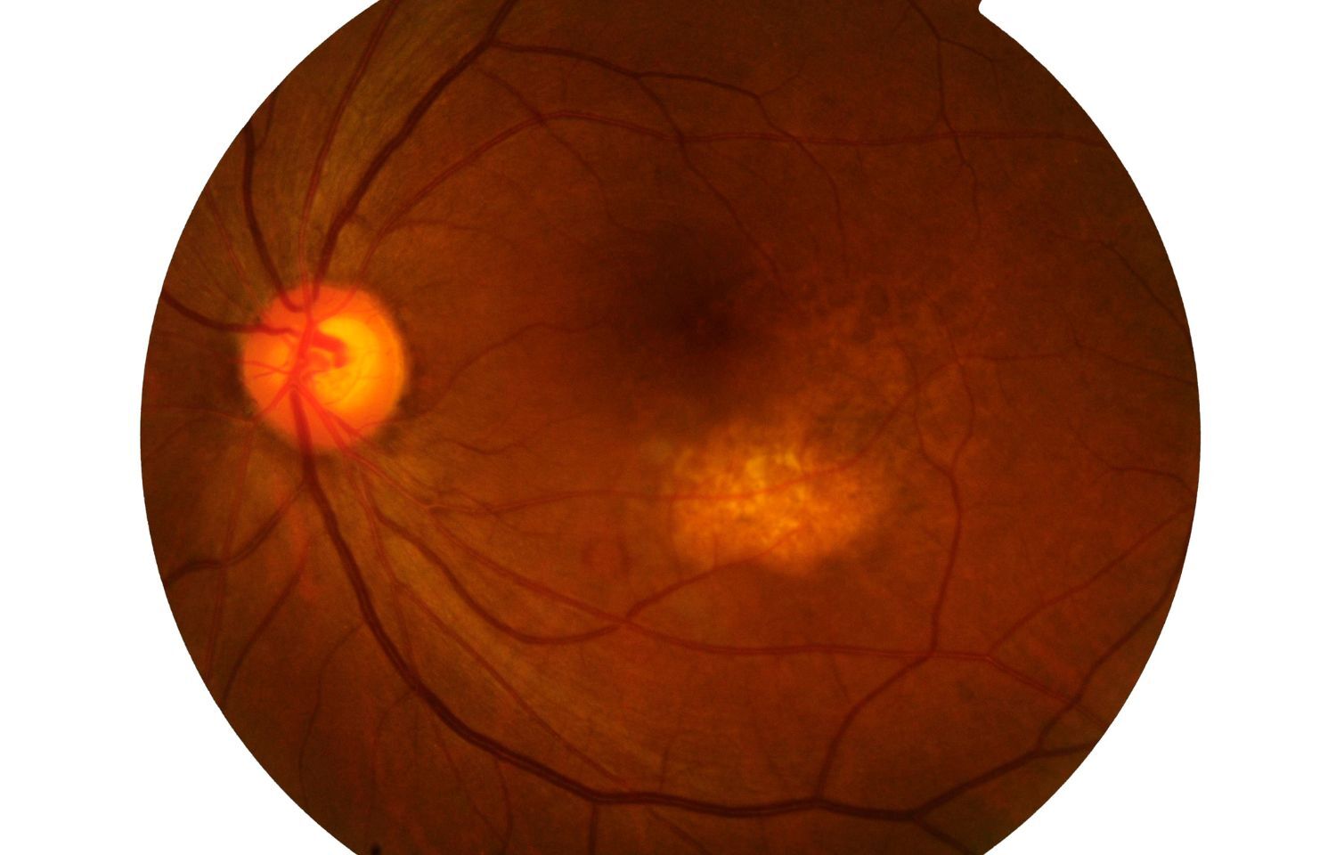 Color FAF imaging - A novel diagnostic Biomarker for Posterior Uveitis ...