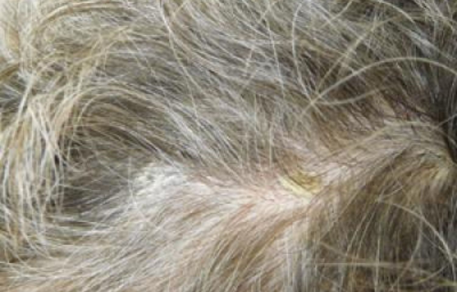 Development of pityriasis amiantacea following topical minoxidil use ...