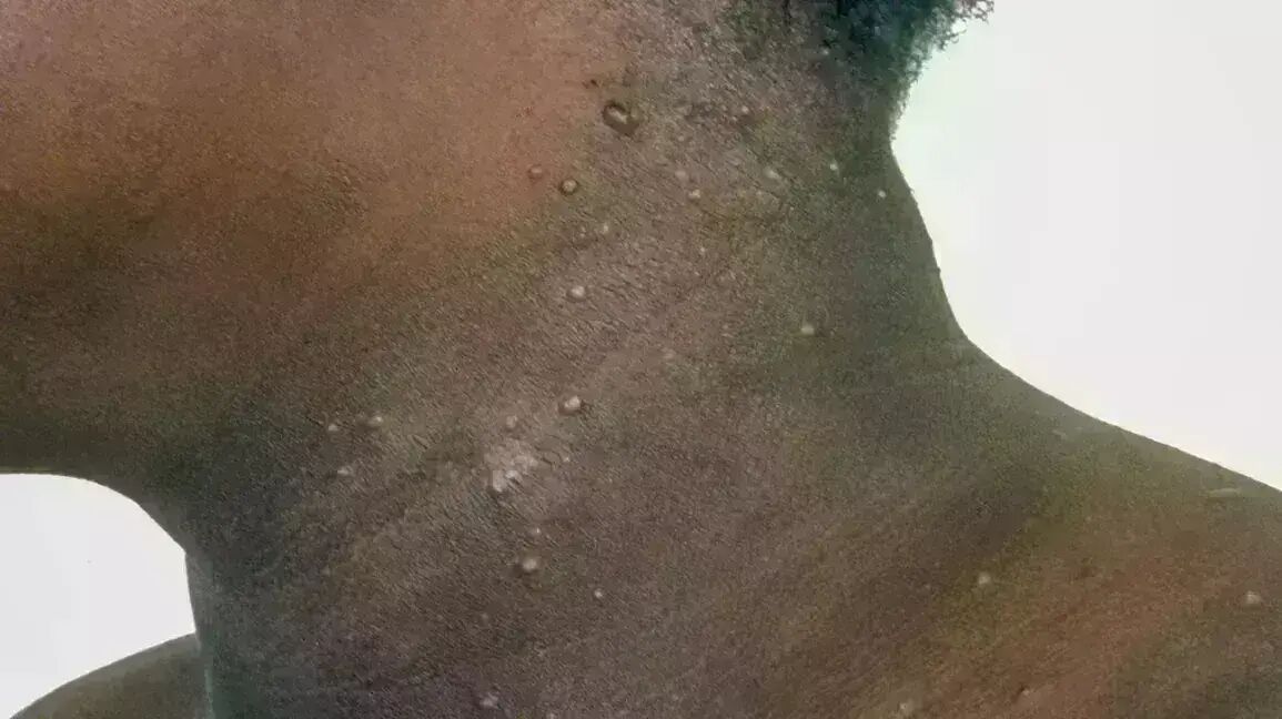 Topical berdazimer gel safe and effective therapy for molluscum ...