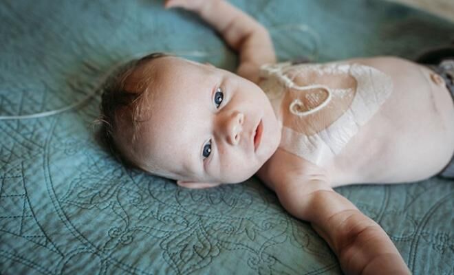 Screening for Cystic Fibrosis improves Nutritional status and Pulmonary ...