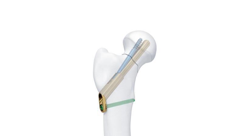 FNS implant a minimally invasive alternative to DHS in treatment of ...