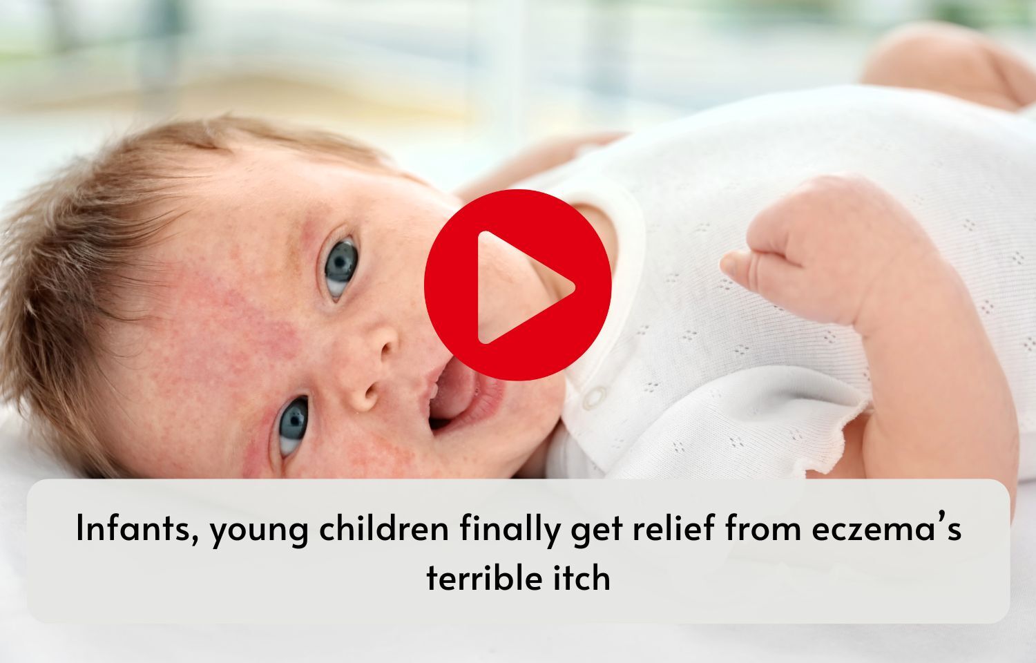 Infants, young children finally get relief from eczema's terrible itch