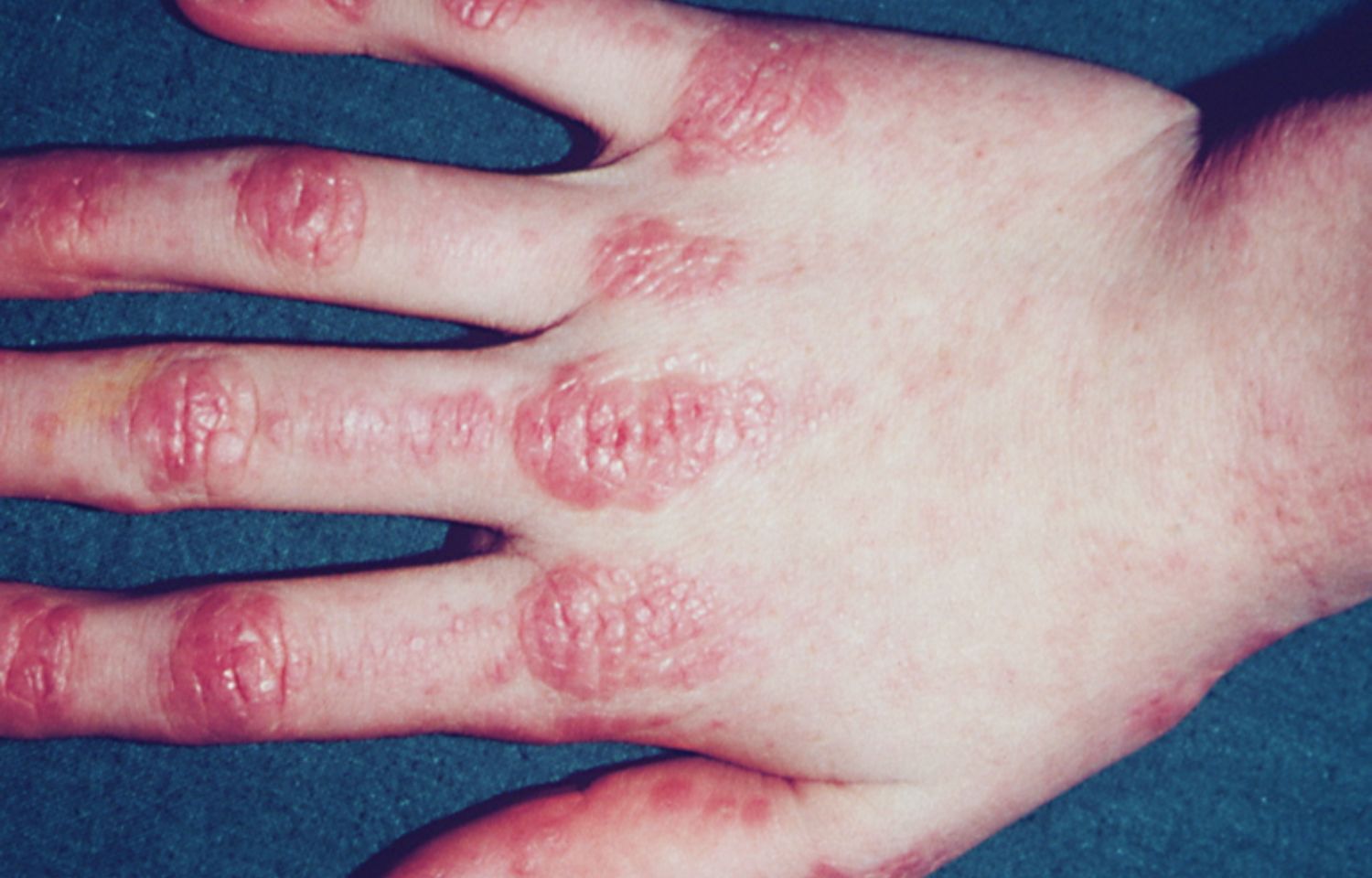 Lenabasum effective and safe treatment for amyopathic dermatomyositis