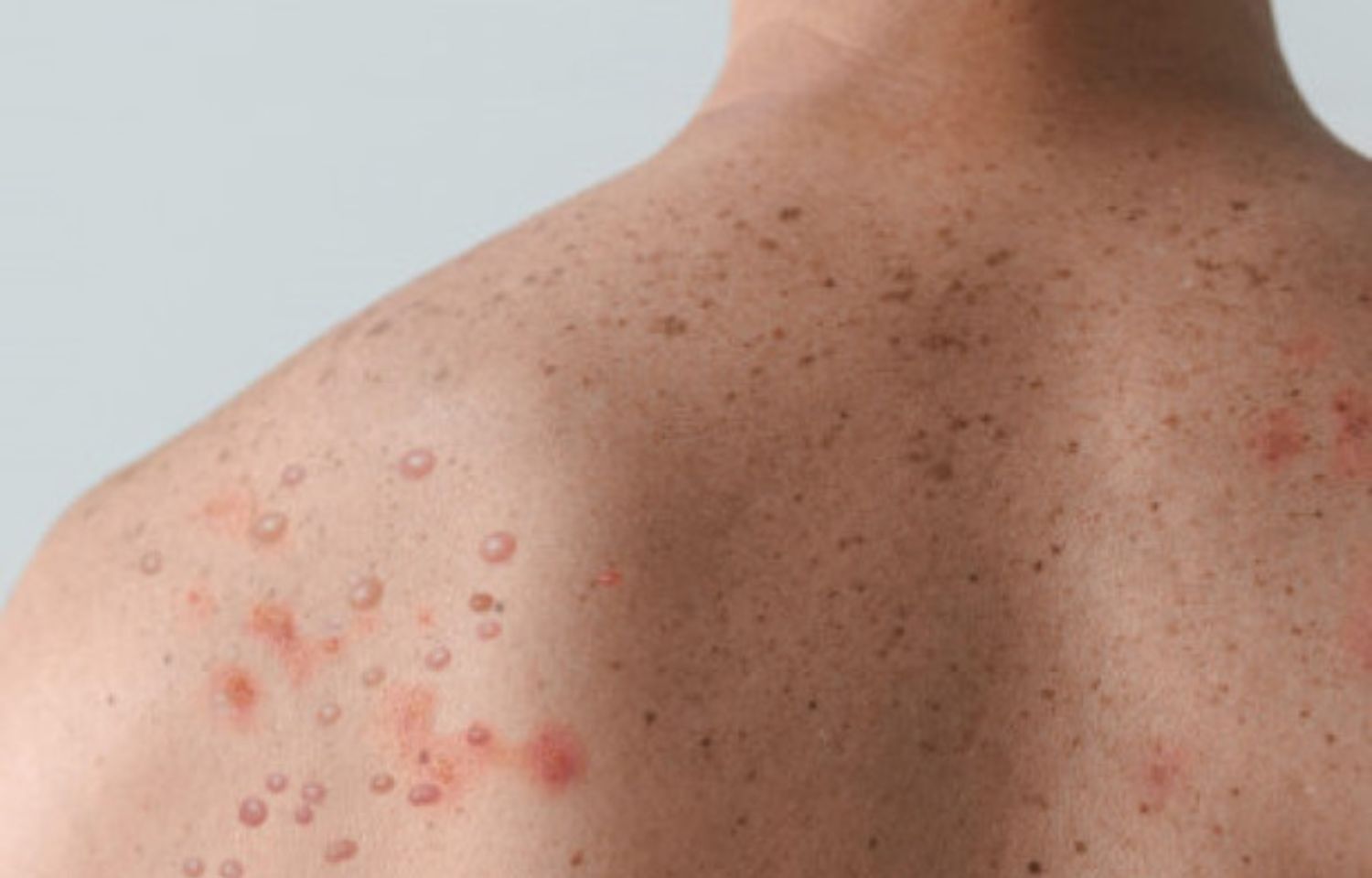 Researchers identify another monkey virus poised for spillover to humans