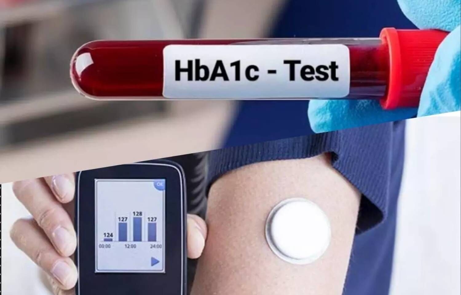 Intermittent CGM monitoring tied to higher HbA1c reduction compared to ...