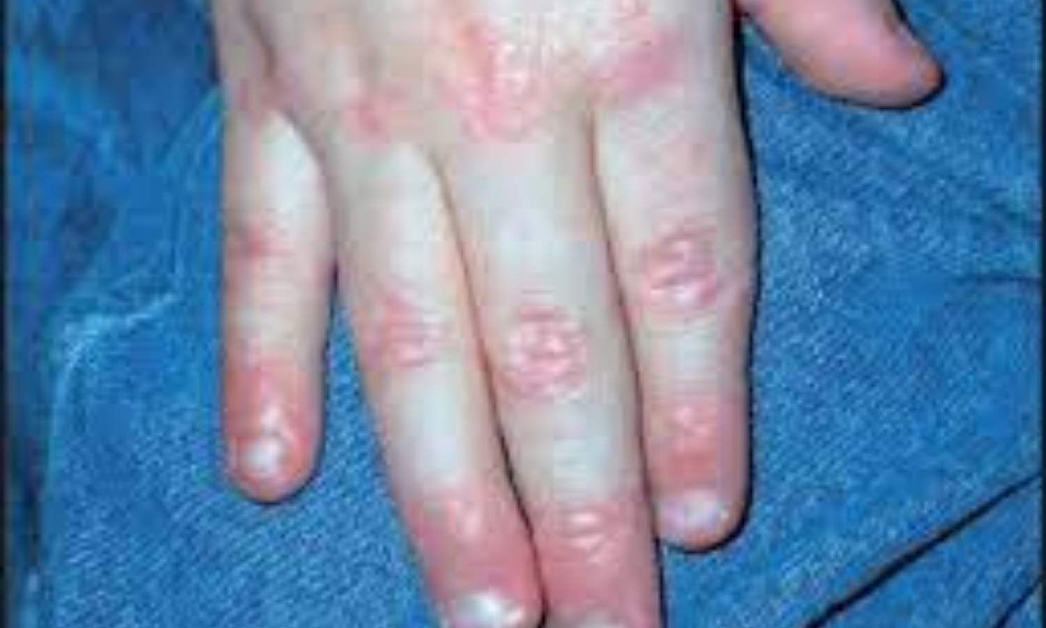 Apremilast effective in treating Recalcitrant Cutaneous Dermatomyositis