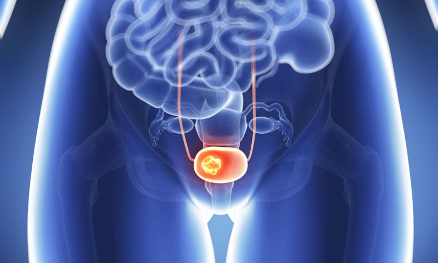 Body Size Linked to Higher Bladder Cancer Risk in Men: Study