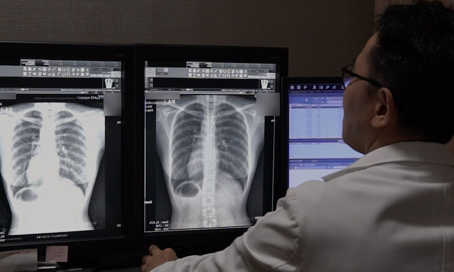 AI tools can detect significant coronary artery disease from chest ...